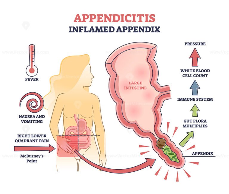 Appendicitis Symptoms Abdominal Medical Problem Diagnosis Outline